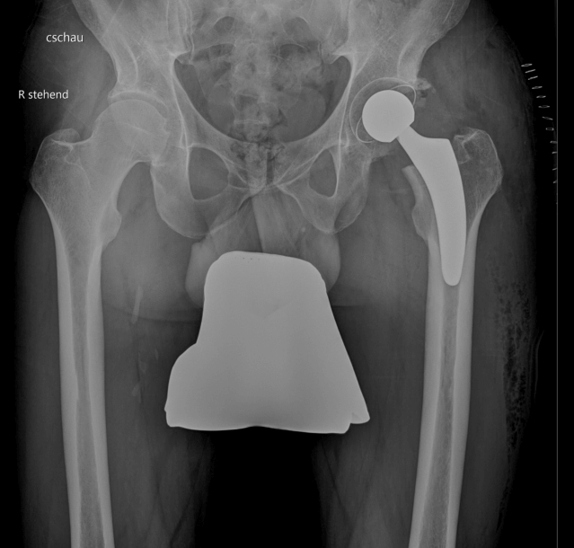 Hüft-TEP (Hüftprothese) - ARCUS Kliniken