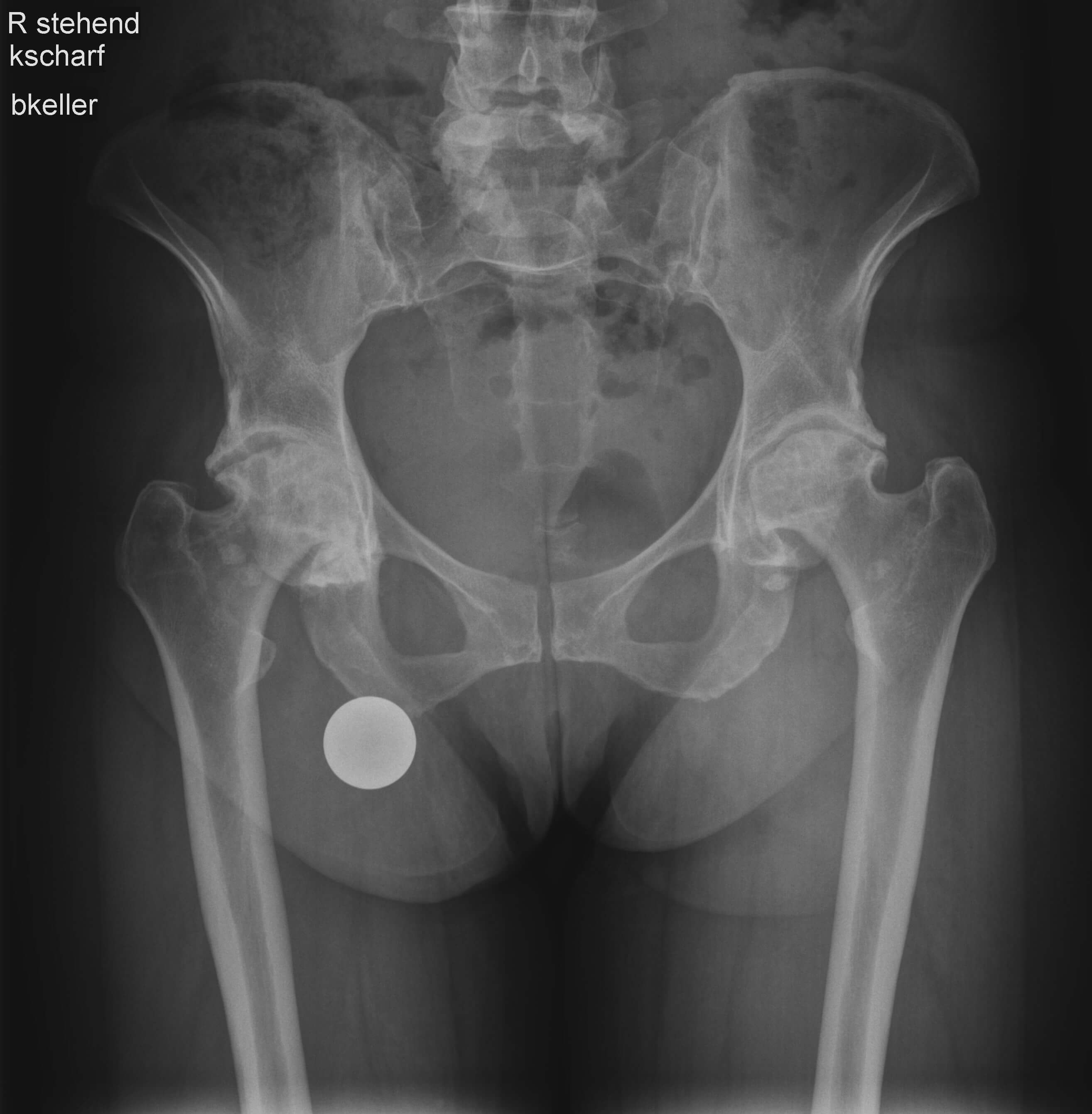 Hüftarthrose (Coxarthrose) - ARCUS Kliniken