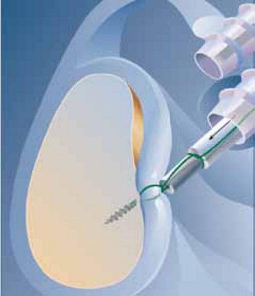 Schulterluxation (Auskugelung) - ARCUS Kliniken